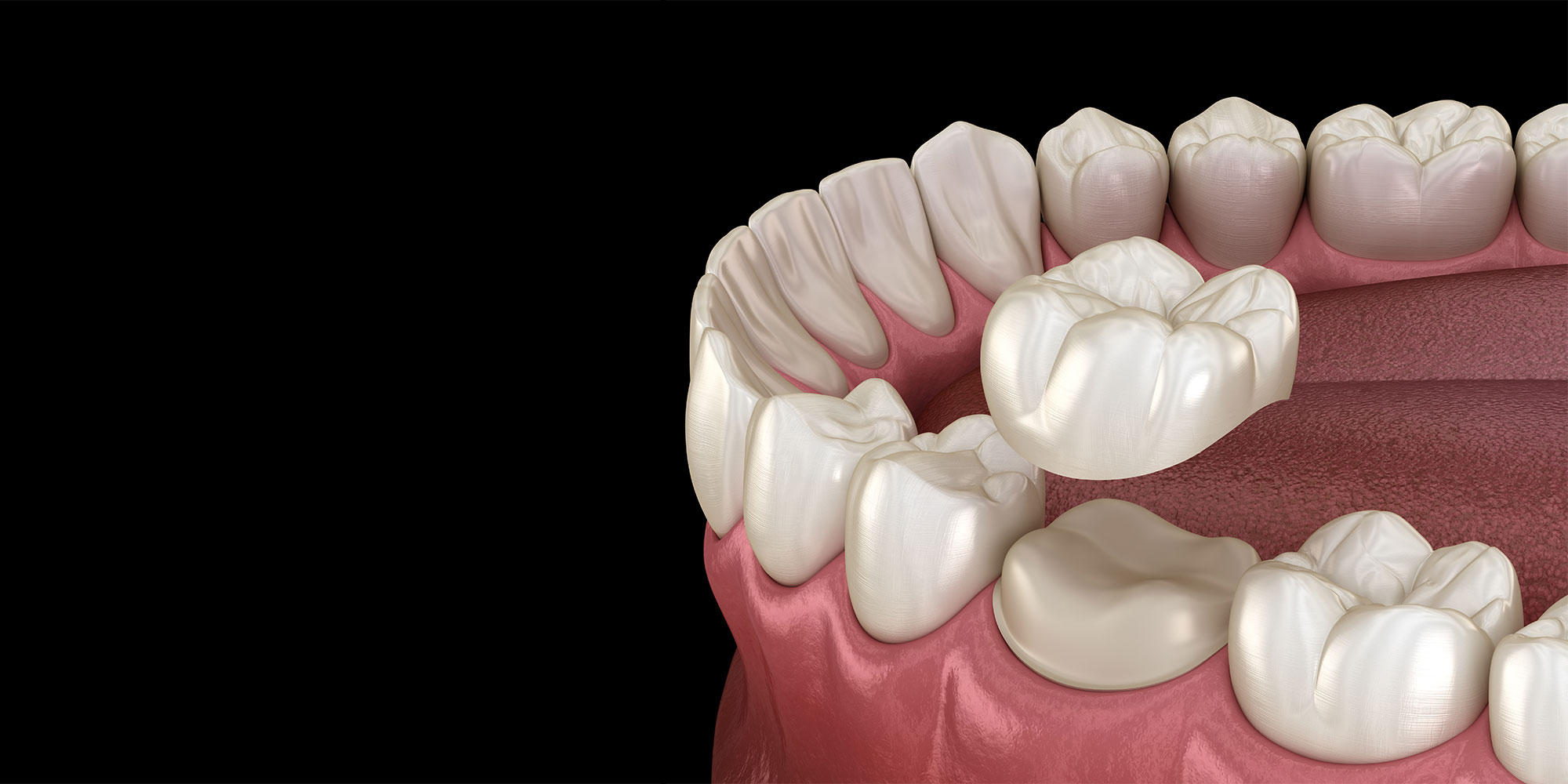 Same-day CEREC Crowns | Restorative Dentist in Flowood or Jackson